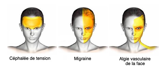 Les céphalées | Récap' IDE