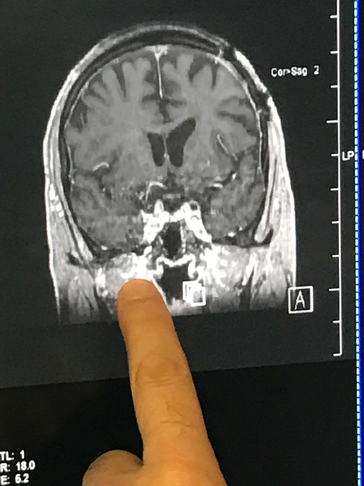 Brain cancer is...: Mucky Bone Pancake