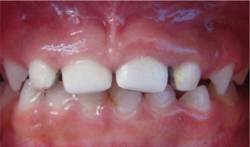 Ortodoncia: Anomalias De Los Dientes