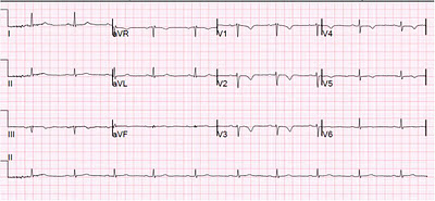 Phimaimedicine: 1,416. Poor R wave progression