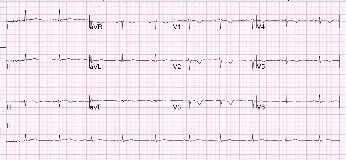 Phimaimedicine: 1,416. Poor R wave progression