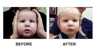 Medical Treatment Pictures-for Better Understanding: Strabismus Surgery ...
