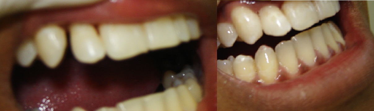 Blog da Ortodontia: Meus dentes são separados...têm solução?