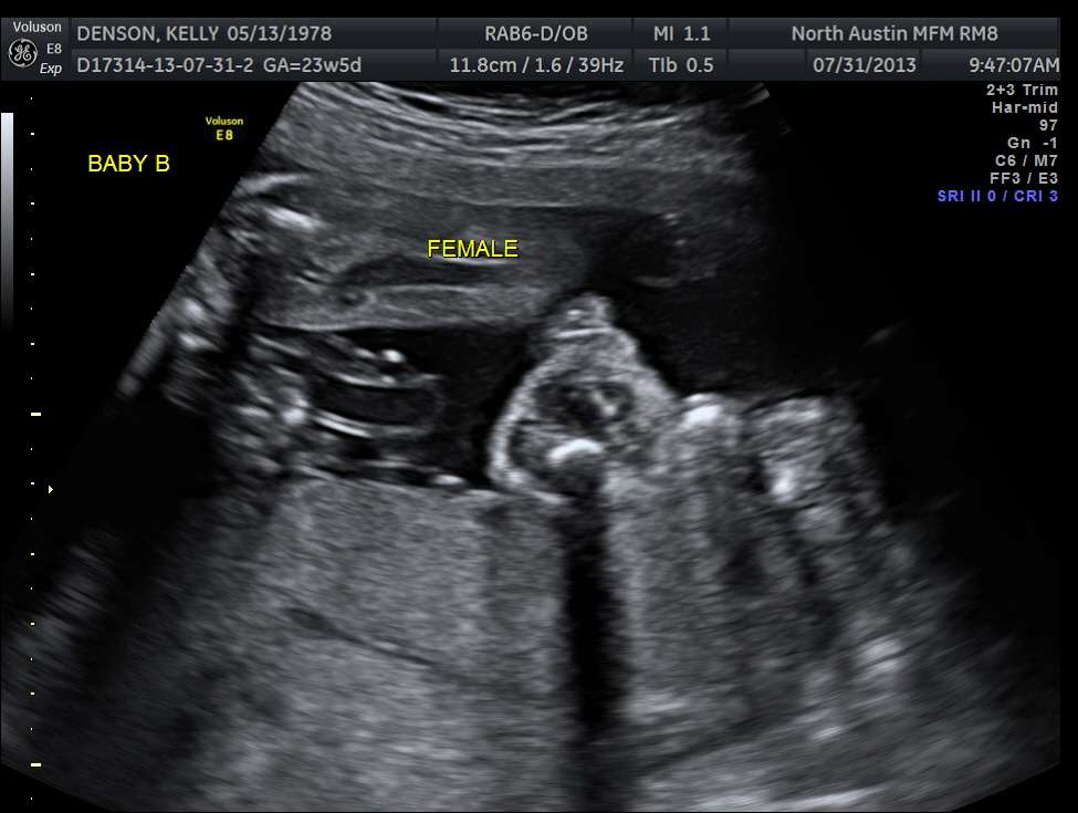 The Texas Trio: A Triplet Pregnancy Blog: Ultrasound pics