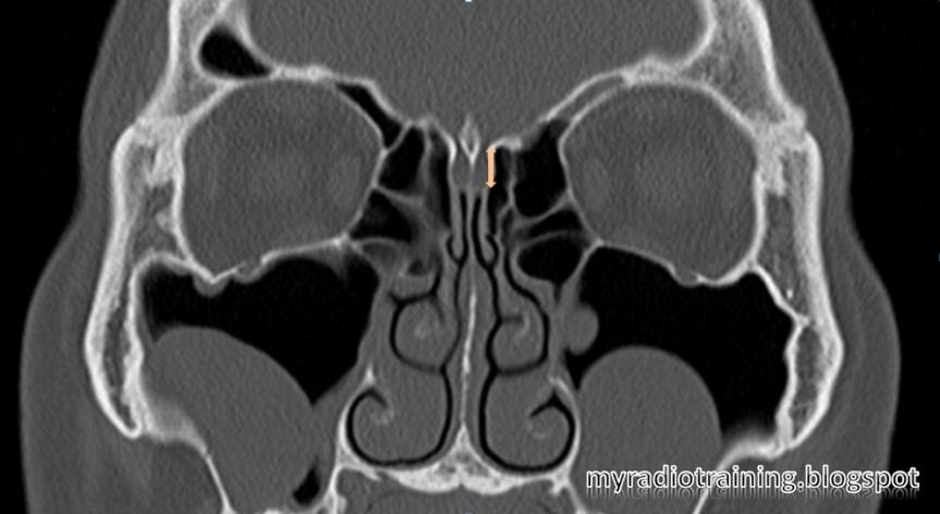 Radiology Info Hub Keros Classification