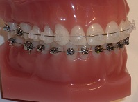 Ortodoncia Damon System. Uruguay, Argentina: El Sistema Damon