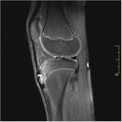 Osgood Schlatter Disease Mri
