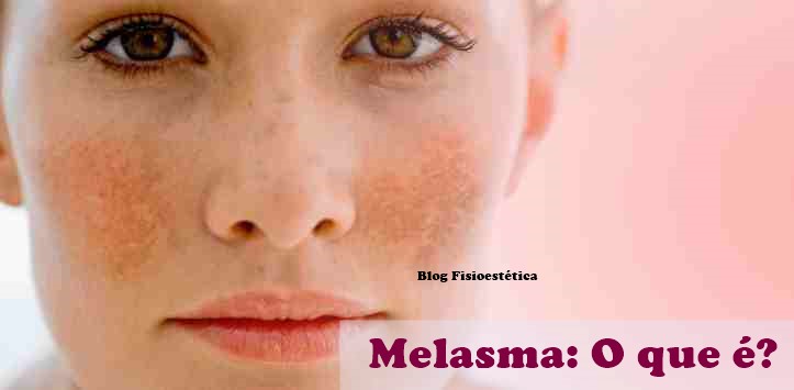 Melasma: O que é? (post #1 saga dos melasmas) | FisioEstética