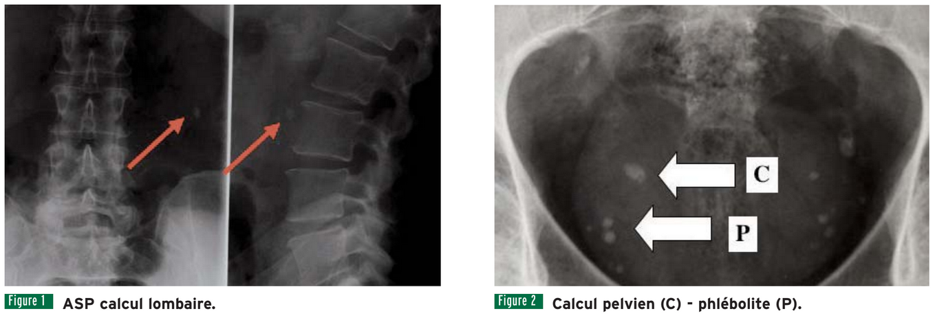 Lithiase urinaire - Documents de Médecine