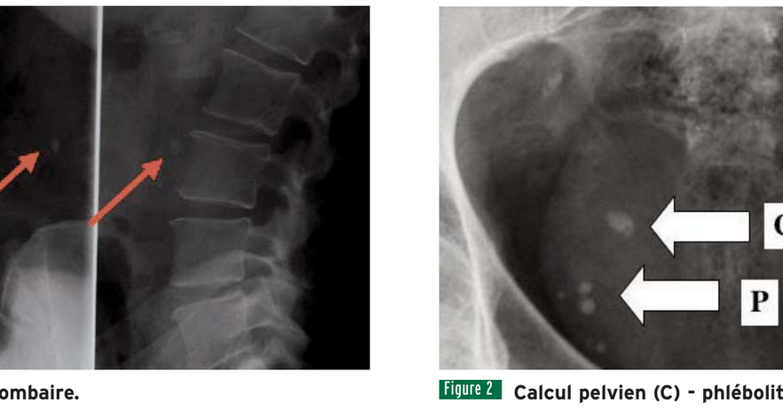 Lithiase urinaire - Documents de Médecine