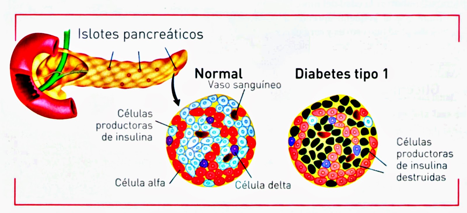 Diabetes en niños y niñas: causas y tratamientos contra la diabetes ...