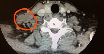 Bianca's Blog: Vergrote lymfklieren