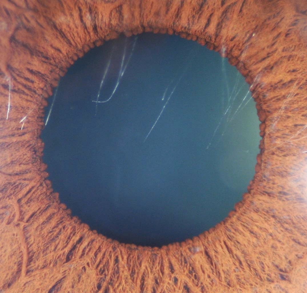Modern & Multidimensional Iridology: Inner Pupillary Border ...