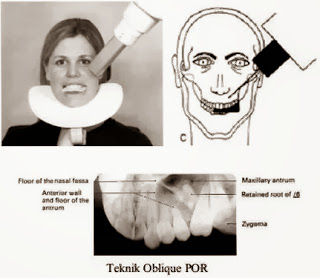 Teknik Radiografi Dental ~ Dent-ias || notes