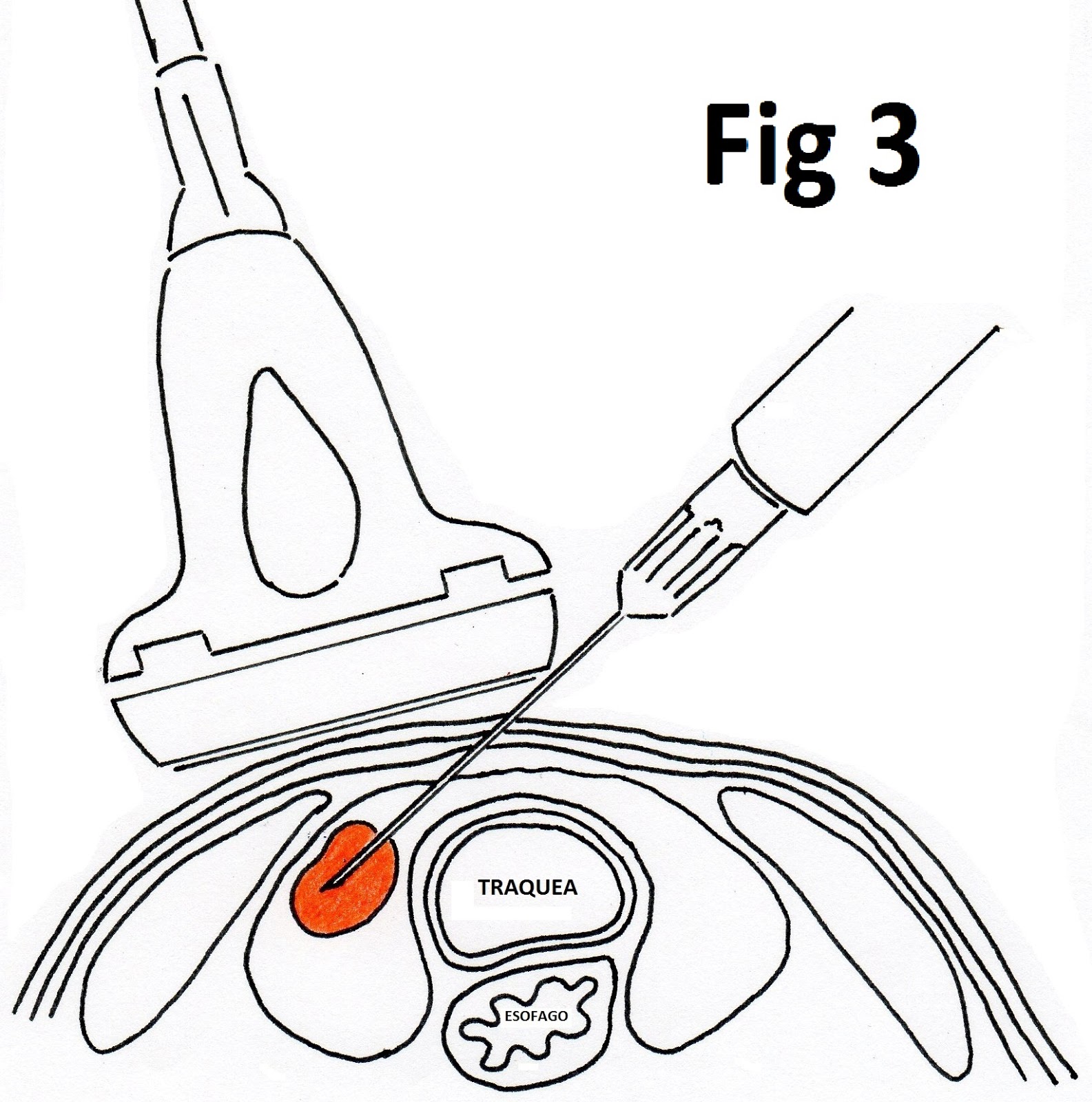 CytoSITE. Asuntos de Citología.: Aspectos Técnicos de la Punción ...