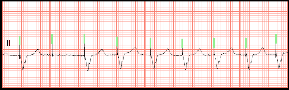 EKG Quiz 361