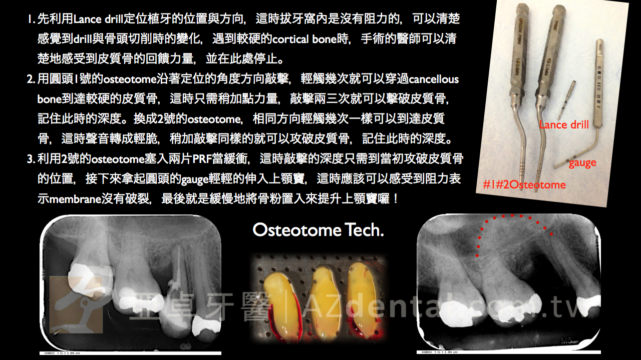 ・城東牙醫_陳政佑醫師・部落格: 立即植牙合併齒脊法上顎竇增高術 immediate implantation with osteotome ...