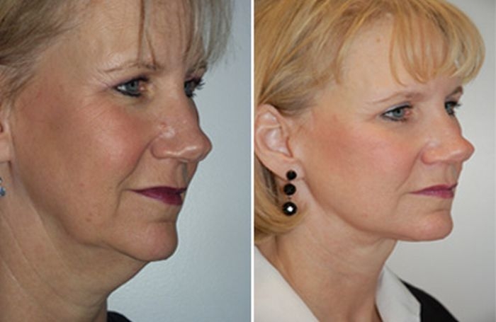 Natural Oriental Facelift By Applying Face Exercises: At Home Holistic ...