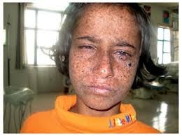 Medical Treatment Pictures-for Better Understanding: Xeroderma Pigmentosum