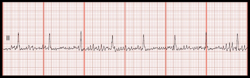 Float Nurse: Practice EKG Rhythm Strips 207