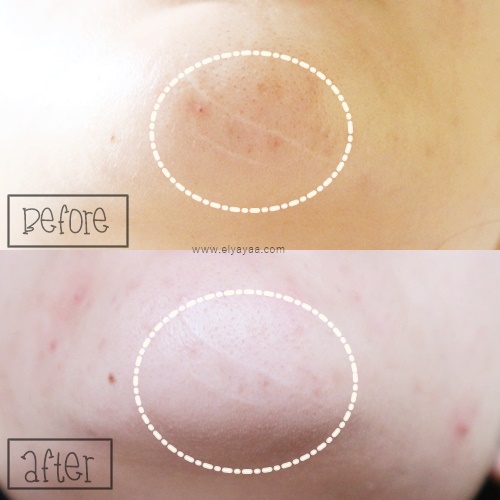 Review: Laderma Scar Repair Cream (Cream Penghilang Bekas Luka) - Ell's ...