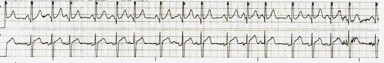ECG Channel: Sinoatrial Block or Sinoatrial Exit Block