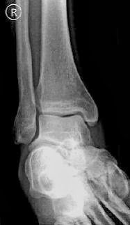 ZONA RADIOLOGY: Teknik Pemeriksaan Radiografi Ankle Joint