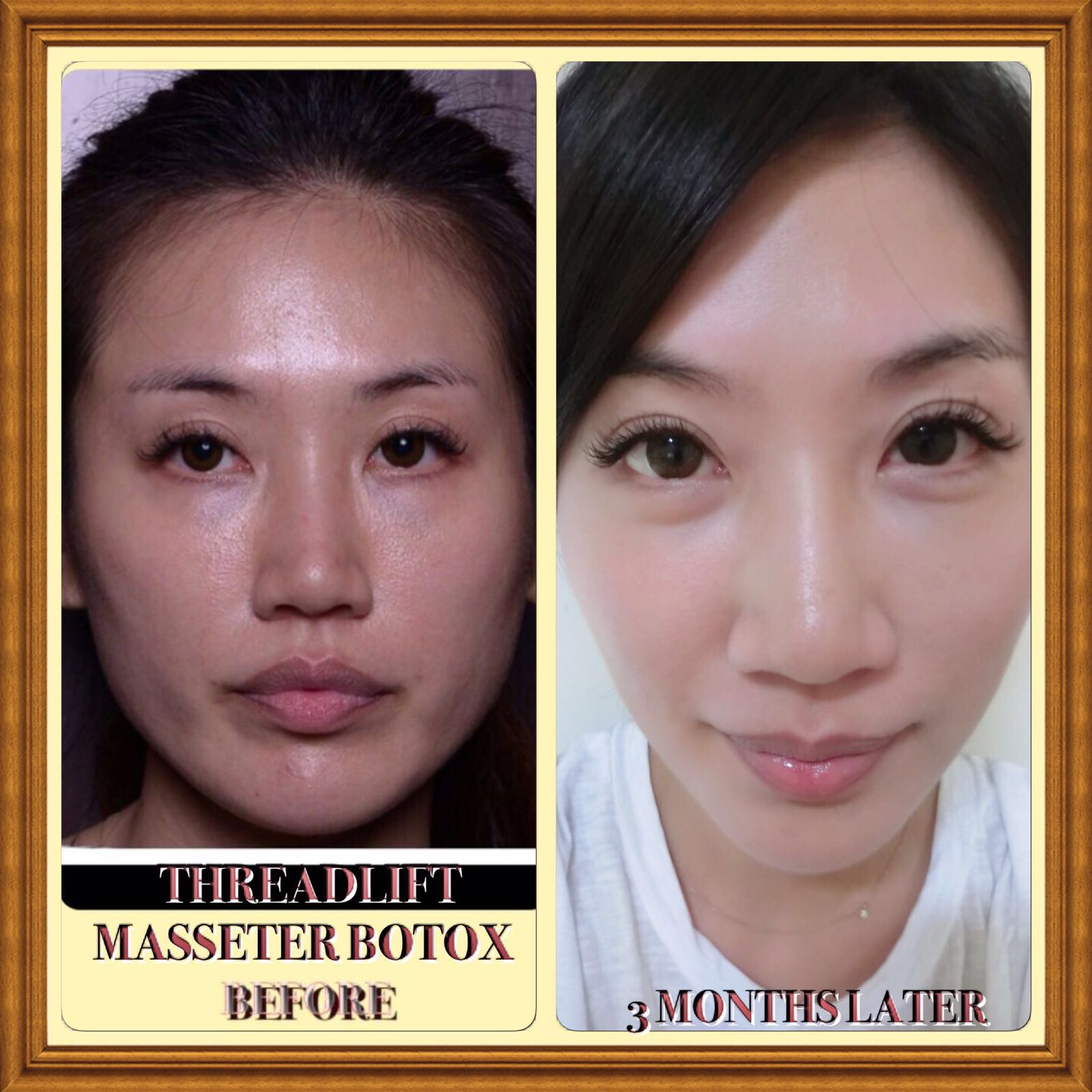 Live A Life You Will Remember : My Threadlift Review with Dr Israr Wong ...