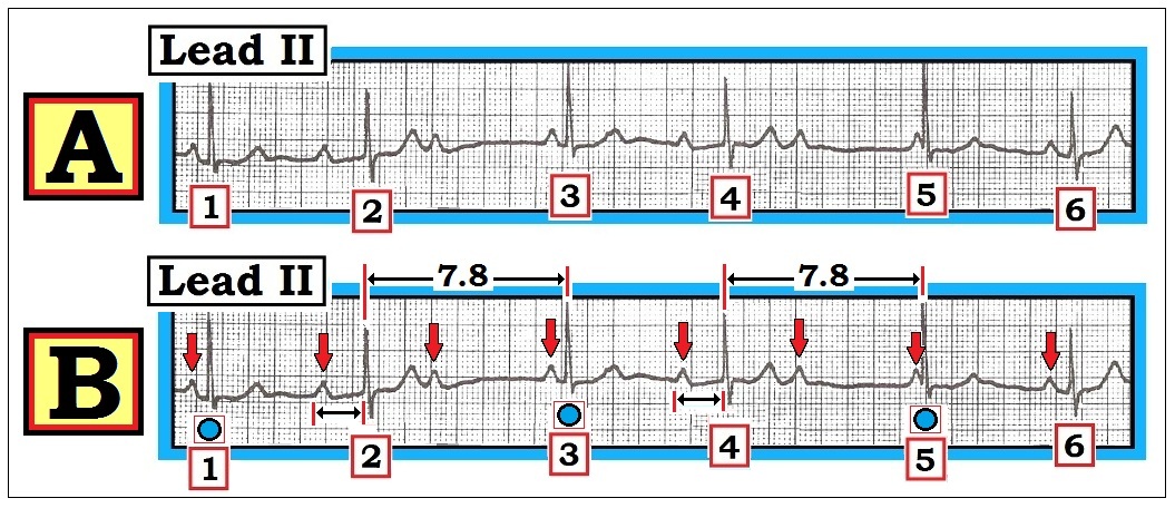 ECG Interpretation: ECG Blog #63 — Escape from Mobitz I