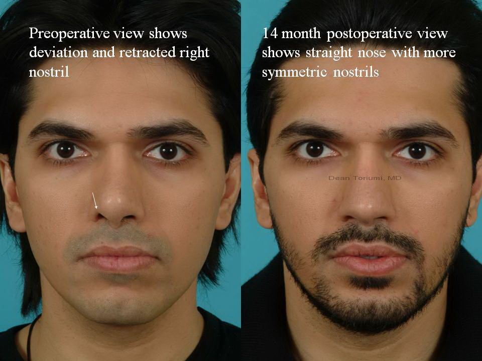 Dr. Dean Toriumi Reviews: Dean Toriumi Reviews: Nasal length restored ...