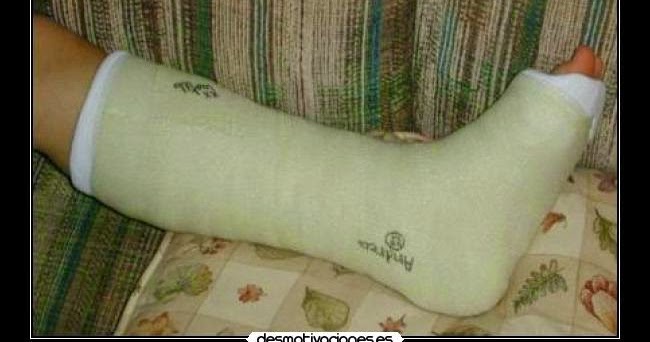 Traumatología y...: Un clásico: El uso del yeso