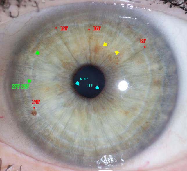 Modern & Multidimensional Iridology: Neurogenic, Vogt's Limbal Girdle ...