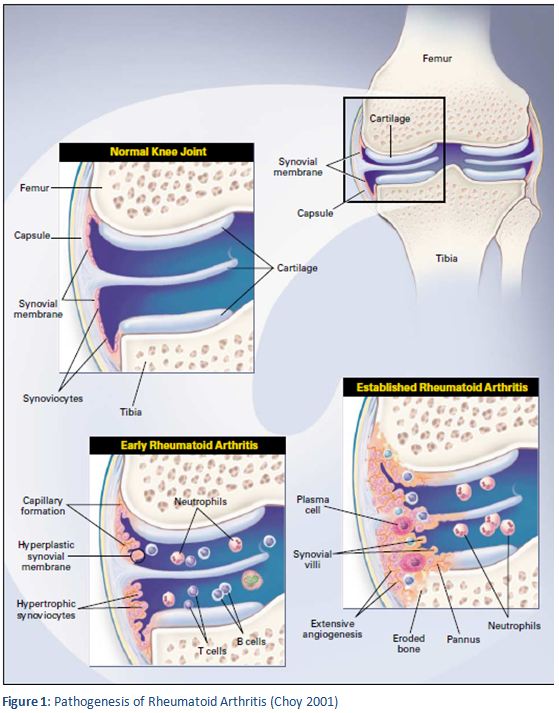 Expatriados Online: Rheumatoid Arthritis: Overview, Molecular ...