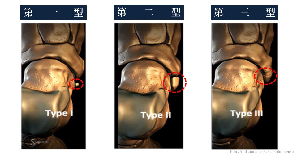 走四方客製鞋墊: 腳踝內側的骨頭特別突出--附生舟狀骨症候群 (Accessory navicular syndrome)