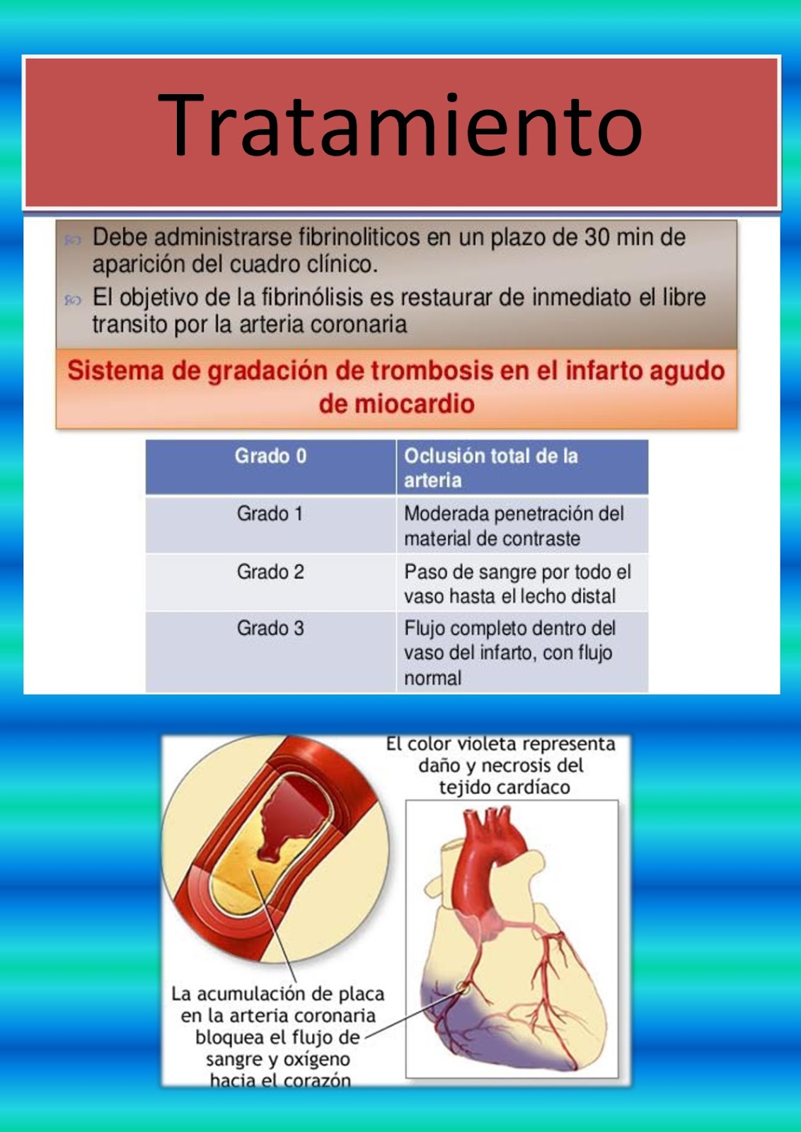 Fibrinólisis extrahospitalaria. Isabel Torres Caballero.