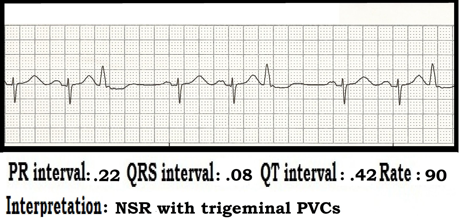 ECG Rhythm Strip Quiz 89: Interval measurements