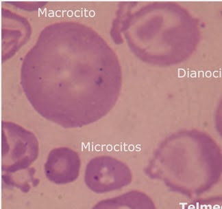 Fichero de Hematología: Anormalidades Eritrositarias.