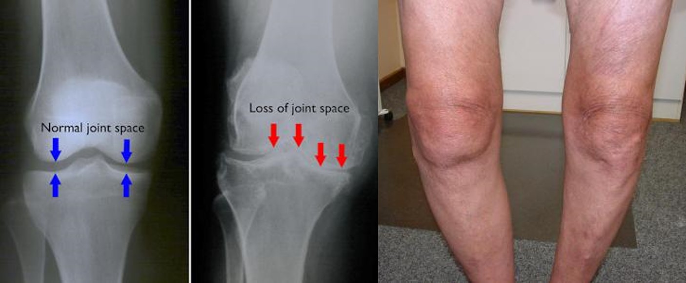 Nyeri Otot-Sendi & Cedera Olahraga. Kenapa Bisa Terjadi dan Apa yang ...
