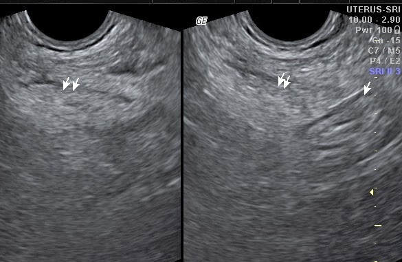 SONO DIGEST: EPIPLOIC APPENDAGITIS - An ultrasound diagnosis