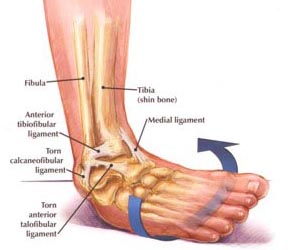 Tips dan Cara Mengatasi Keseleo (Terkilir) ~ Permathic Blog