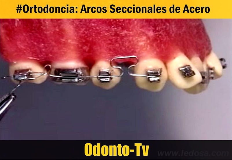 ORTODONCIA: Arcos Seccionales de Acero
