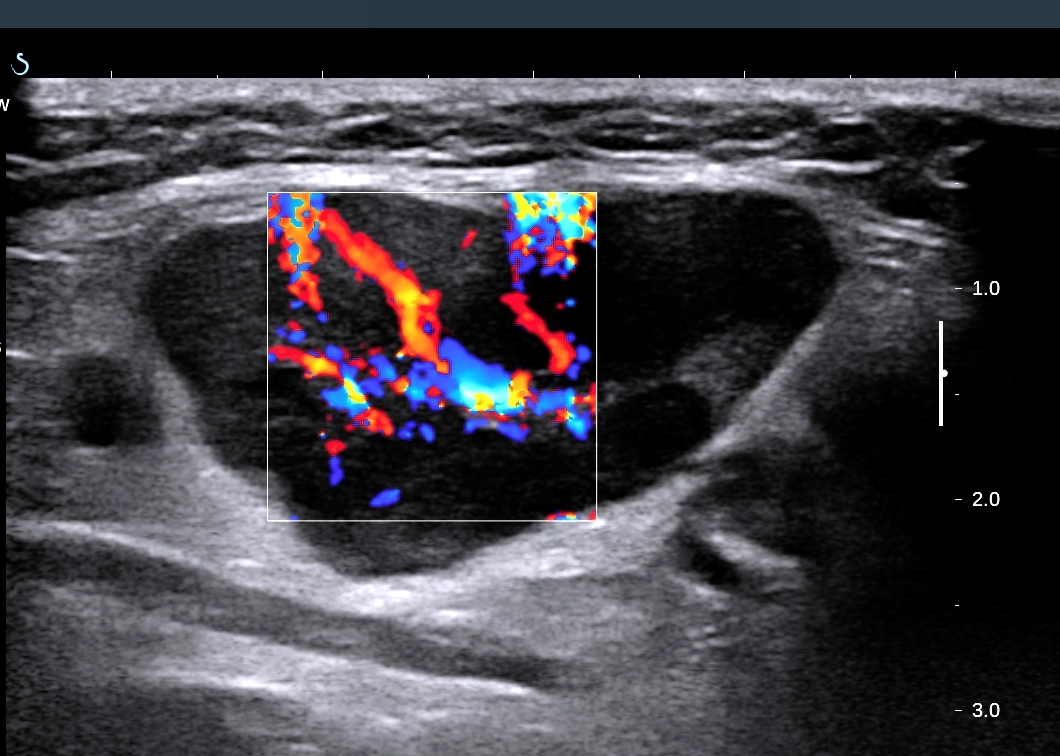 Cervical Lymph Nodes Ultrasound
