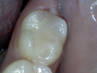 www.BestOgdenDentist.com Blog: "It's just a small cavity. I'll get to ...