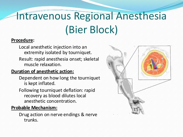 bier block ,what to know?