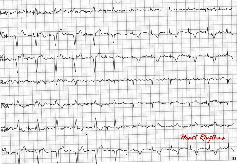 ECG Rhythms: T wave memory/Chatterjee Phenomenon/Cardiac Memory