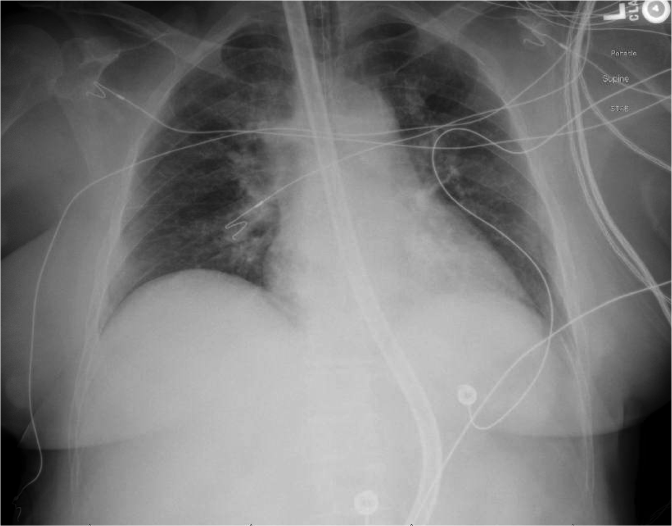 Cardiogenic Pulmonary Edema X Ray