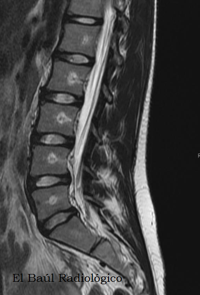 El Baúl Radiológico: VENAS BASIVERTEBRALES. (Basivertebral Veins: CT ...