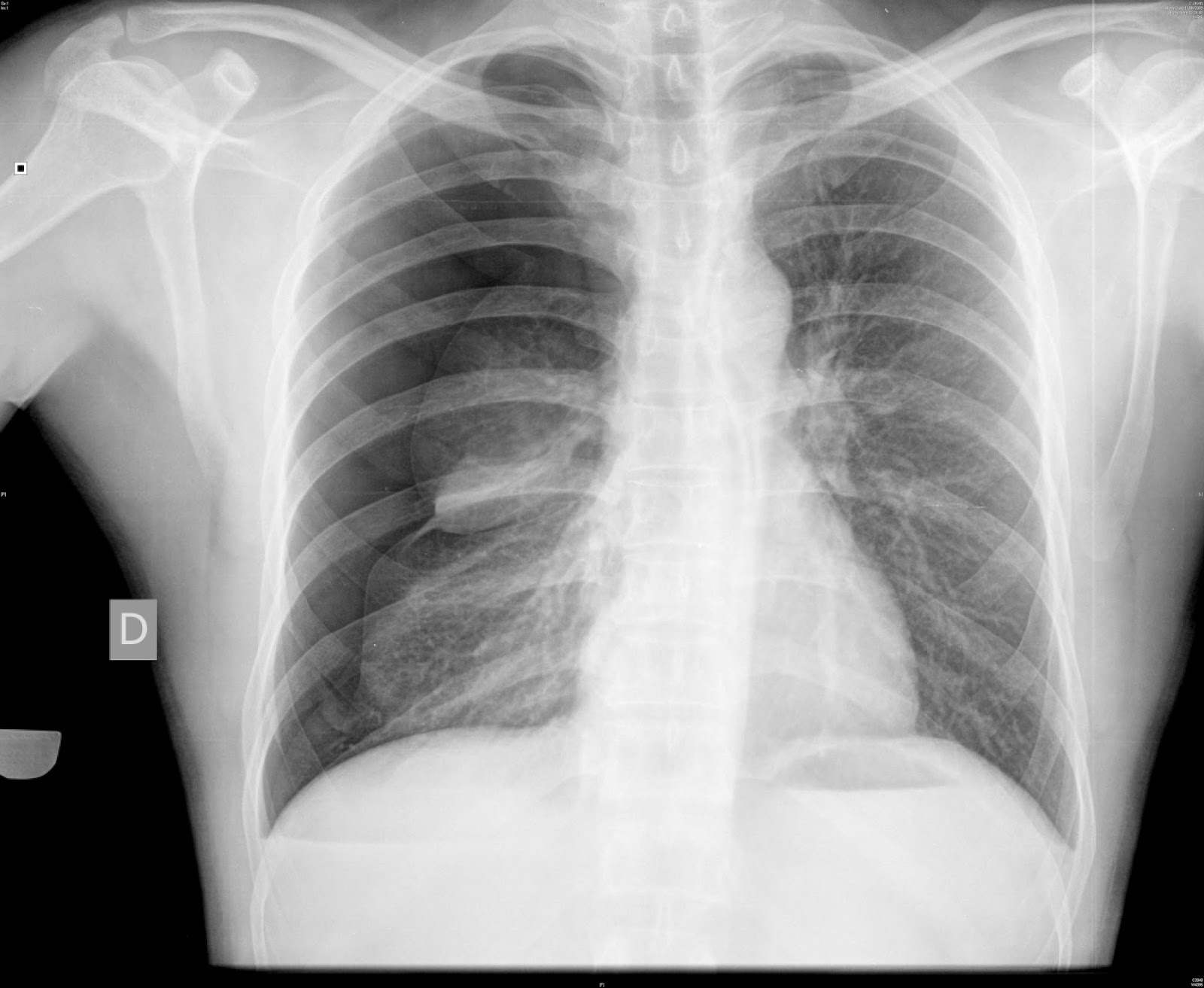 Medical Review : Neumotorax