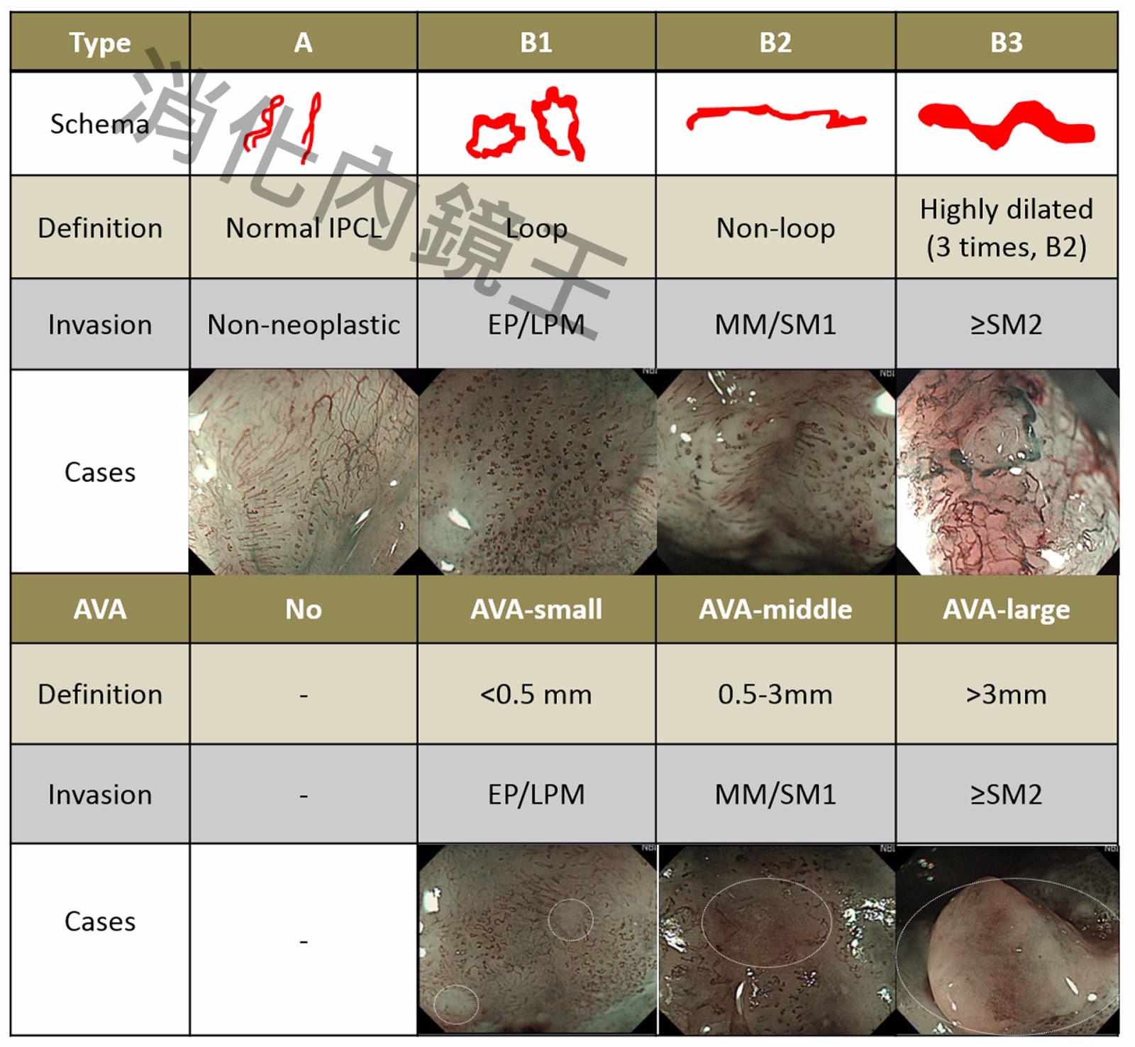 消化內鏡王 - King of digestive endoscopy : IEE在食道的應用