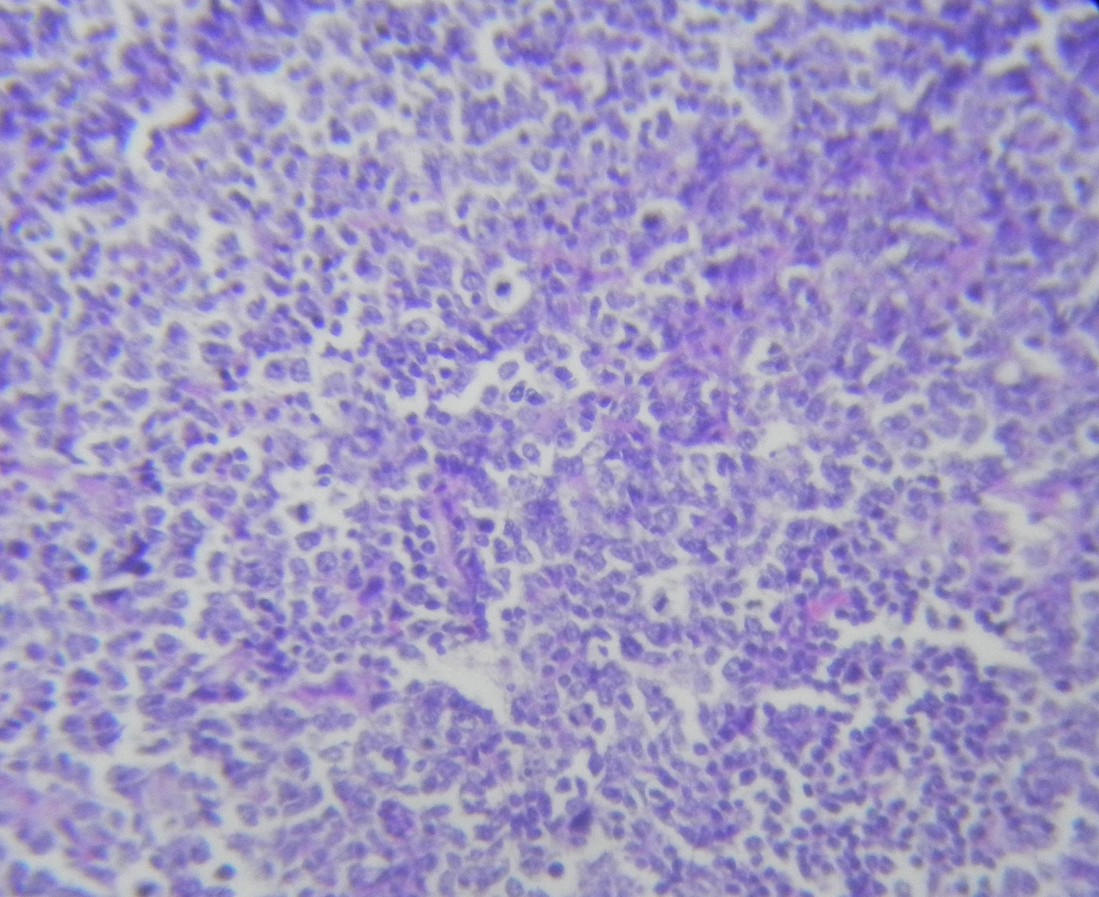 into the roots: A difficult lymph node